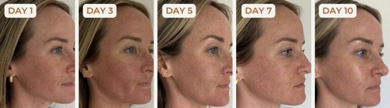 My Painfully Honest Fraxel Review - Before/After Pics - So Much Life