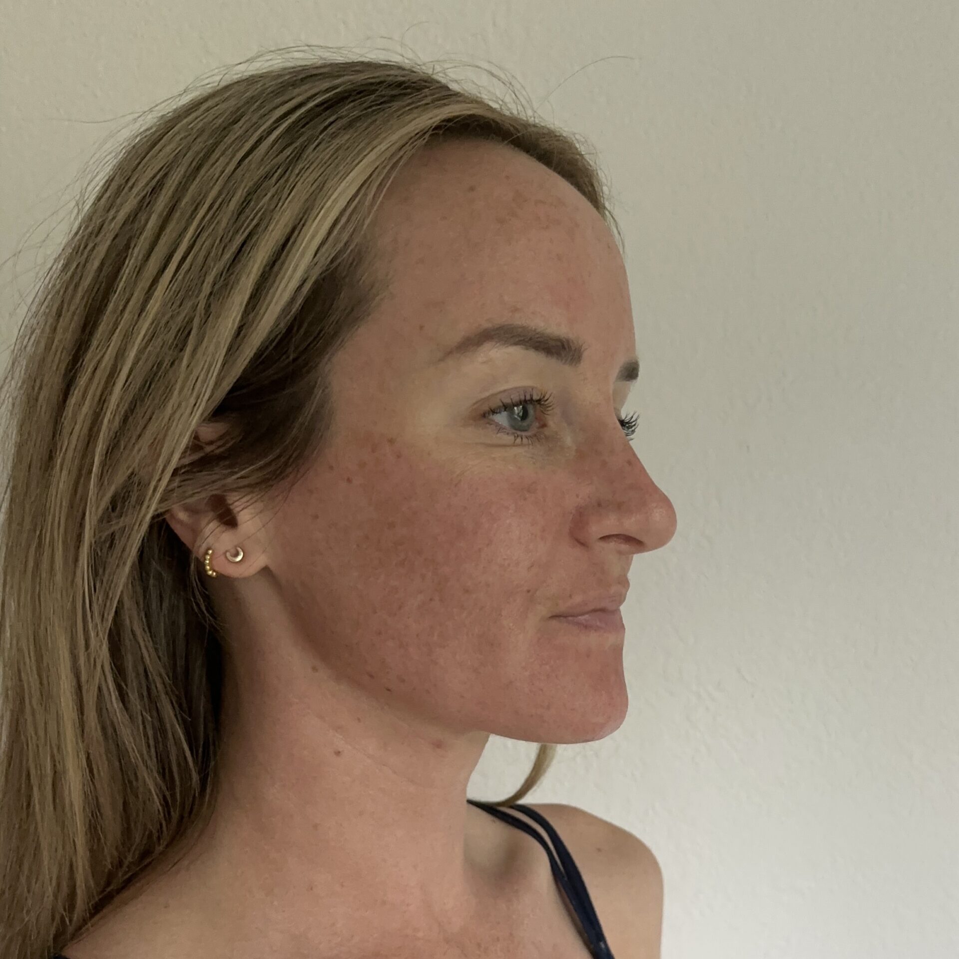 My Painfully Honest Fraxel Review - Before/After Pics - So Much Life