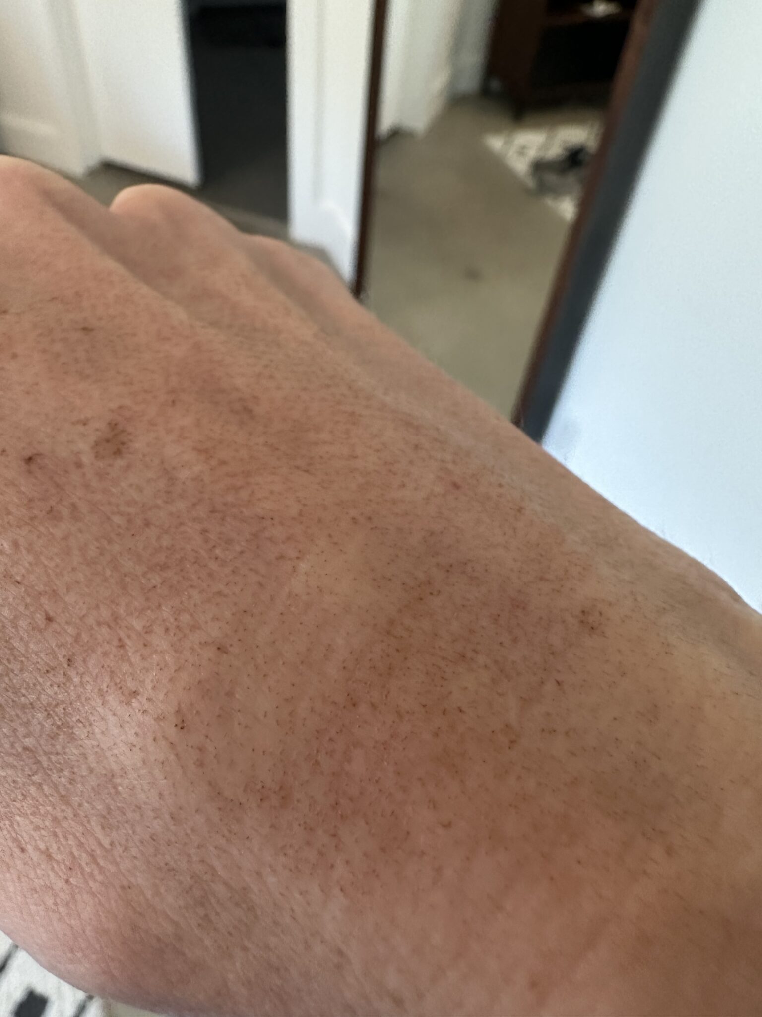 My Painfully Honest Fraxel Review - Before/After Pics - So Much Life